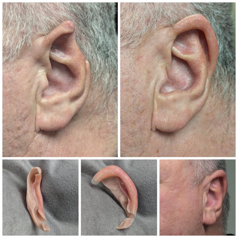 Prosthetic Ear Finally Makes Man Happy and Whole Again