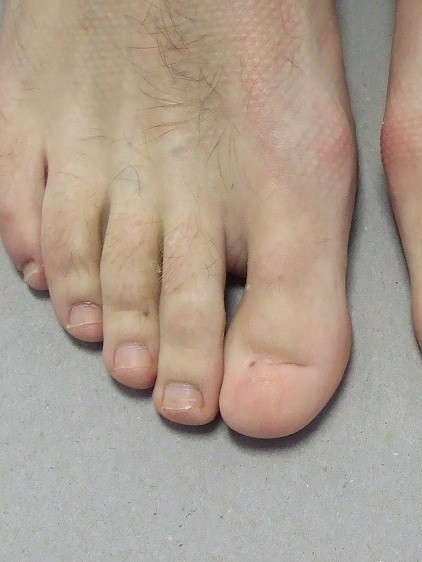 Prosthetic Toe – The Medical Art Prosthetics, LLC