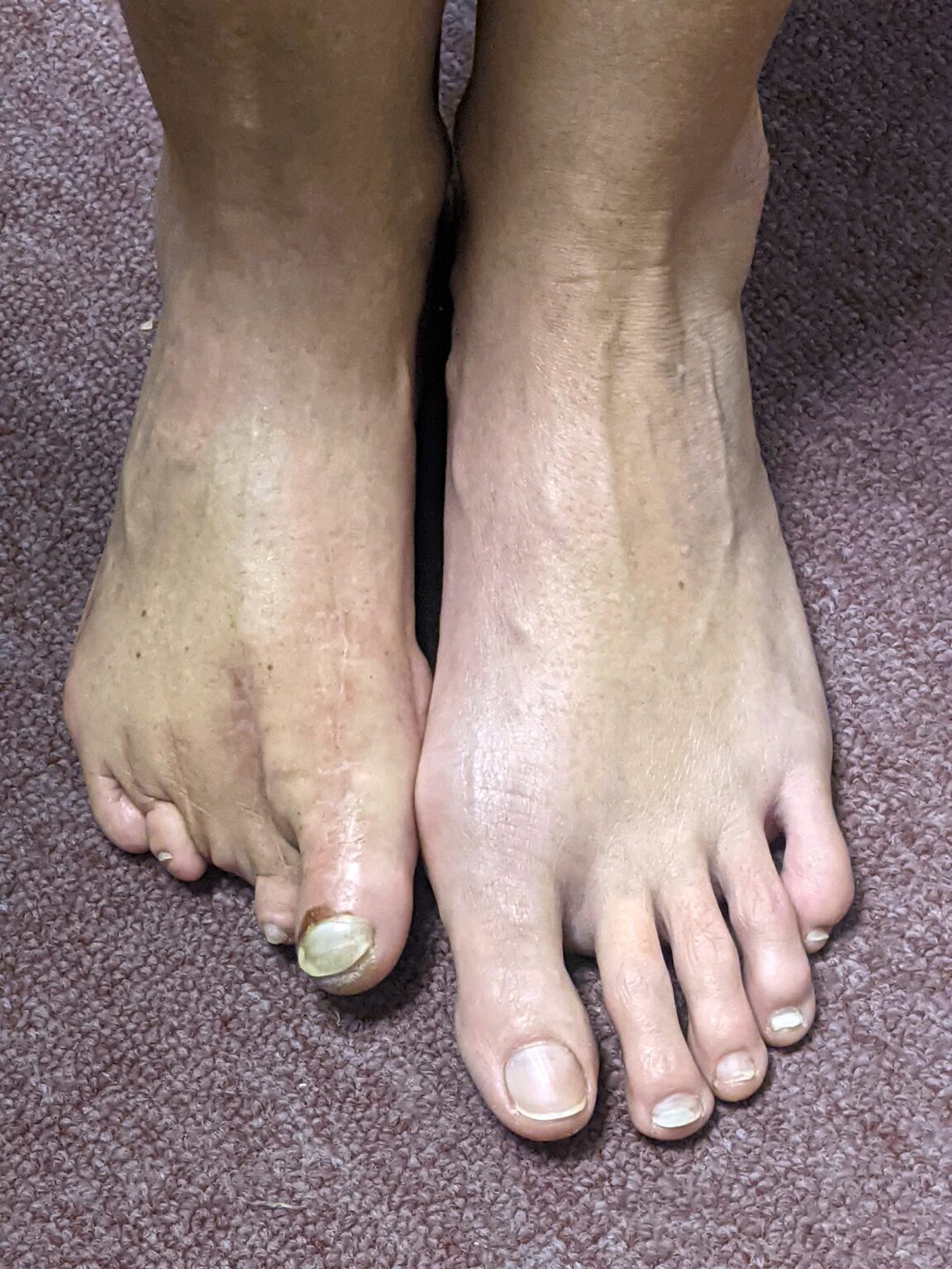 Quality Custom Silicone Foot and Toe Prosthetic